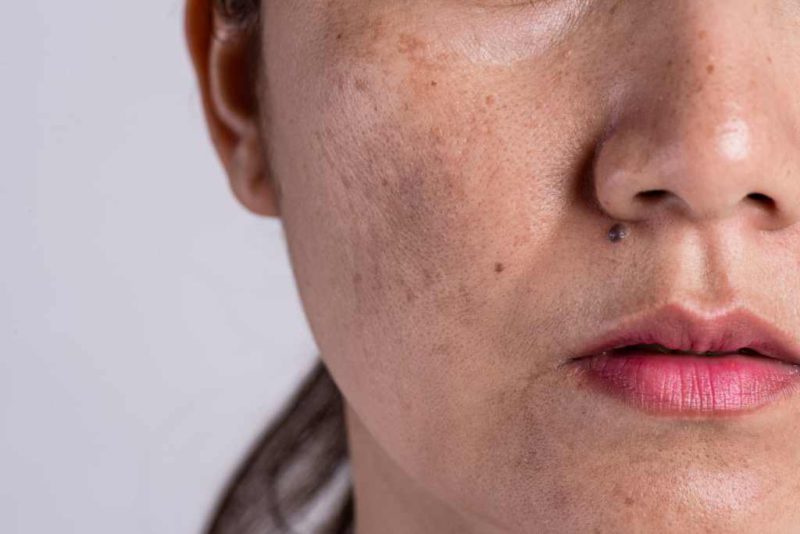 Xeroderma Pigmentosum: Gejala, Penyebab, Diagnosis, dll