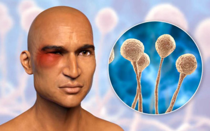 Penyakit Jamur Hitam: Gejala, Penyebab, Pengobatan, dll - DokterSehat