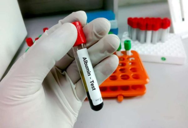Pemeriksaan Albumin: Fungsi, Prosedur, & Cara Membaca Hasilnya