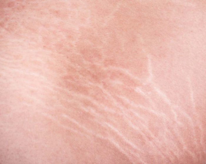 Penyebab Stretch Mark pada Remaja dan Cara Mengatasinya