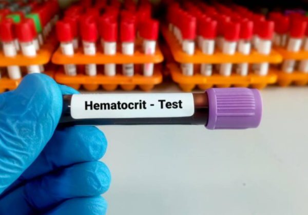 8 Penyebab Hematokrit Rendah yang Harus Diwaspadai - DokterSehat